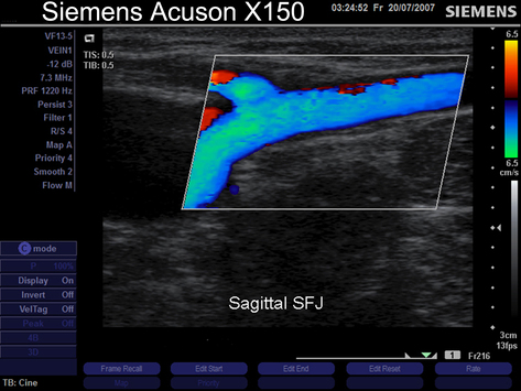 Siemens Acuson X150 Ultrasound Machine